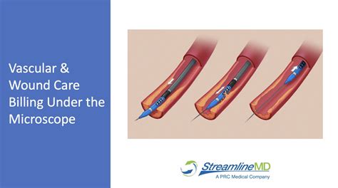 Vertebral Fractures Proper Documentation And Coding Streamlinemd