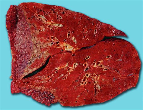 Honeycomb Lung Photograph By Medimagescience Photo Library Fine Art