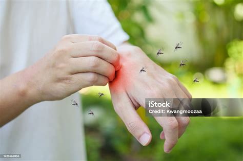 모기에 물린 알레르기 피부 발진 의 원인에서 손에 가려움증과 긁힘 남자 긁음에 대한 스톡 사진 및 기타 이미지 긁음 피부 건강관리와 의술 Istock