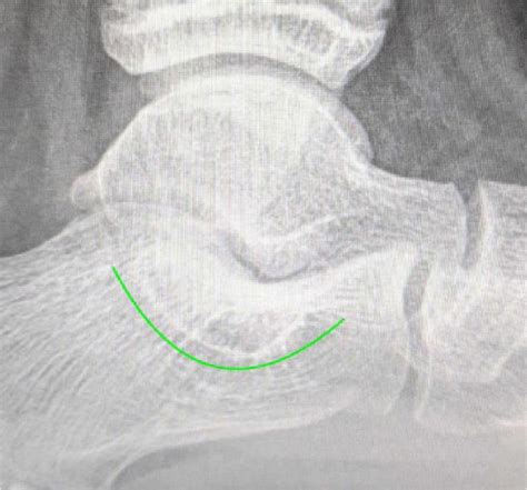 Plain Film Radiograph Exhibiting The C Sign Characteristic Of A