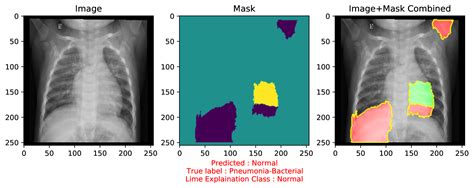 Comprehensive Lung Disease Detection Using Deep Learning Models And Hybrid Chest X Ray Data With