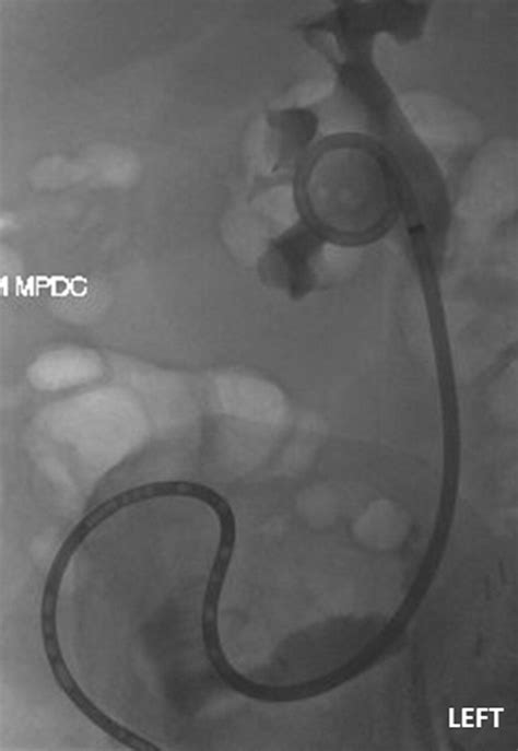 Complications Of Ileal Conduits After Radical Cystectomy Interventional Radiologic Management