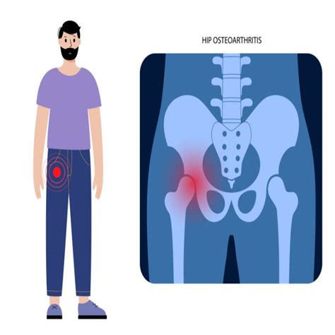 고관절 통증 및 증상 치료하는 법 네이버 블로그