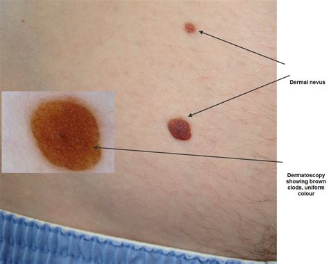 Dermoscopy Made Simple Benign Nevus Dermoscopy Made Simple Benign Nevus