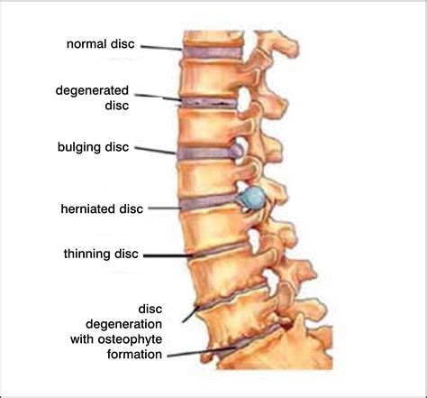 Lumbar Disk Disease Symptoms At Kayla Chirnside Blog