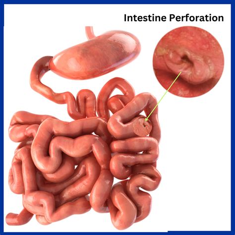Small Intestine Pictures