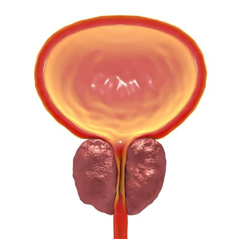 Enlarged Prostate Cancer