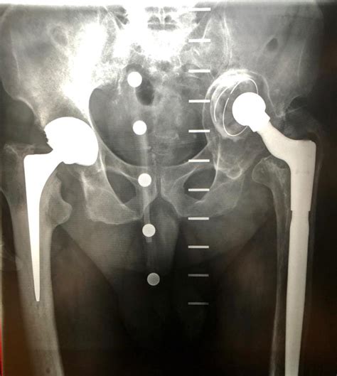 Parag Jaiswal On Linkedin Hipreplacement 18 Comments