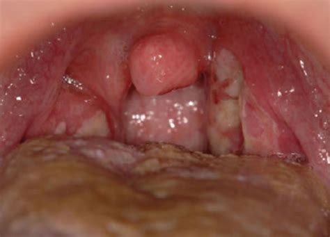 Syphilitic Tonsillitis In Primary Care A Case Report British Journal Of General Practice
