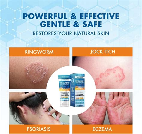 Powerful Antifungal Ringworm Cream Effective Treatment For Stubborn