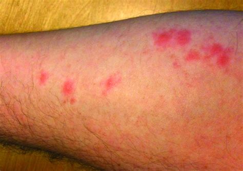 Bed Bug Bites Identification Prevention And Treatment Bed Bug Bites Identification Prevention And Treatment