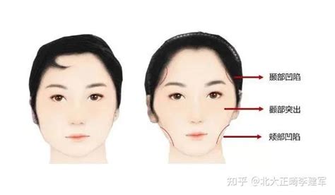 关于牙套脸你了解多少 知乎