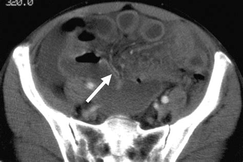 Ct Of Internal Hernias Radiographics