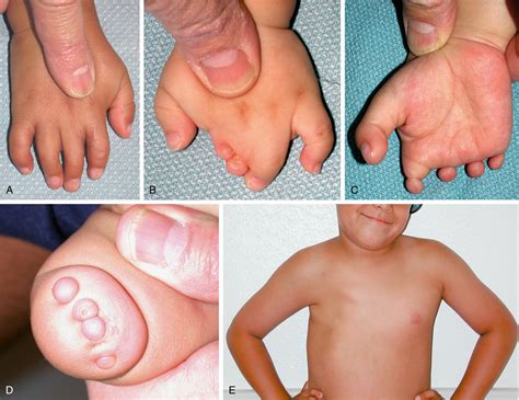 Disorders Of The Upper Extremity Clinical Tree