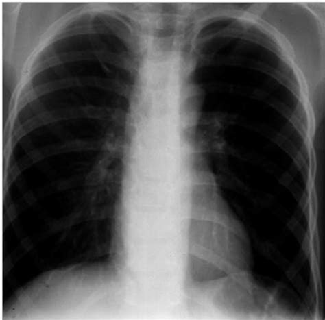 Chest X Ray Enlarged Mediastinum With A Convex Linear Opacity On The