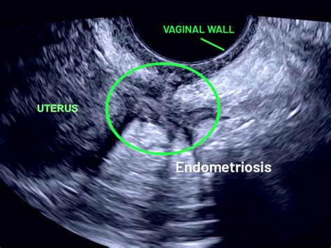 Ovarian Cancer Signs Symptoms And Diagnosis Saint Johns Cancer