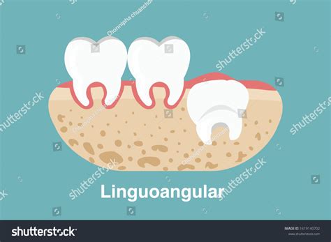 Wisdom Tooth Linguoangular Impaction Illustration Vector Stock Vector