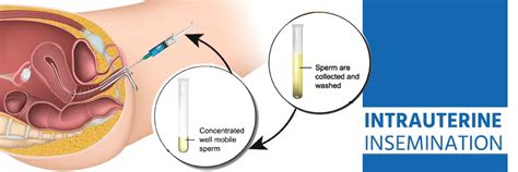 Iui Treatment Cost In India Factors Influencing The Price