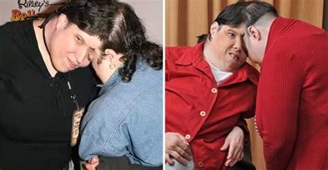 Conjoined Twin Confesses He Hid His True Gender From His Sister For 46