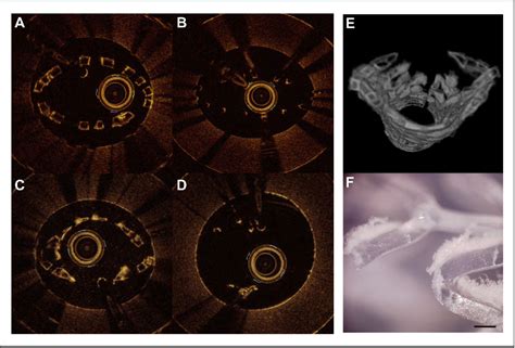 Figure 1 From Do Bioresorbable Scaffold Particles Created By Rotablation Pulverization Come To A