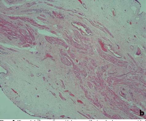 Figure 2 From Suprapubic Percutaneous Assisted Cystoscopic Excision Of Posterior Urethral