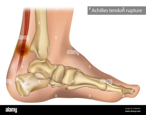 Achilles Tendon Bursitis