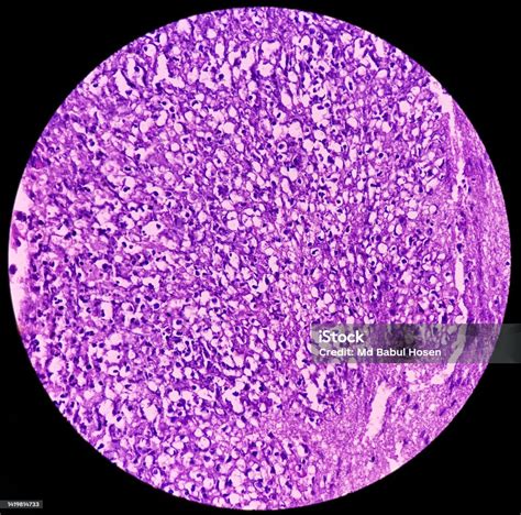 담낭의 화농성 담낭염은 근육 주위 섬유증과 다형체 림프구 히스티오사이트 및 거대 세포의 조밀 한 침윤을 보여줍니다 거대세포 인간의 세포에 대한 스톡 사진 및 기타 이미지