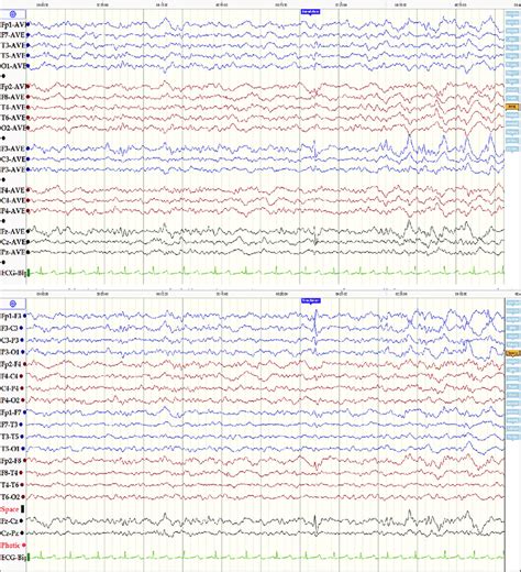 Awake Eeg Showing Normal Background Activity Bottom Longitudinal Download Scientific Diagram