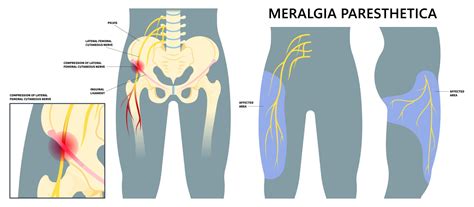 Harnessing The Power Of Pulsed Radiofrequency For The Treatment Of