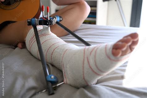 Woman With External Fixation Right Tibial Fracture Stock Photo Adobe Stock