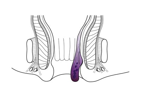 Hemorrhoid Treatment Calgary Na Hemorrhoid Centre