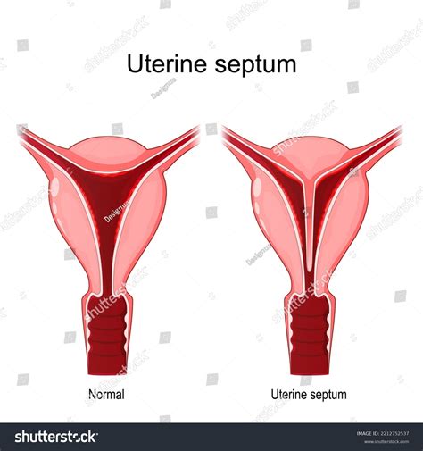 Uterine Septum Comparison Difference Between Normal Stock Vector