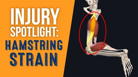Grade 1 Hamstring Strain Symptoms