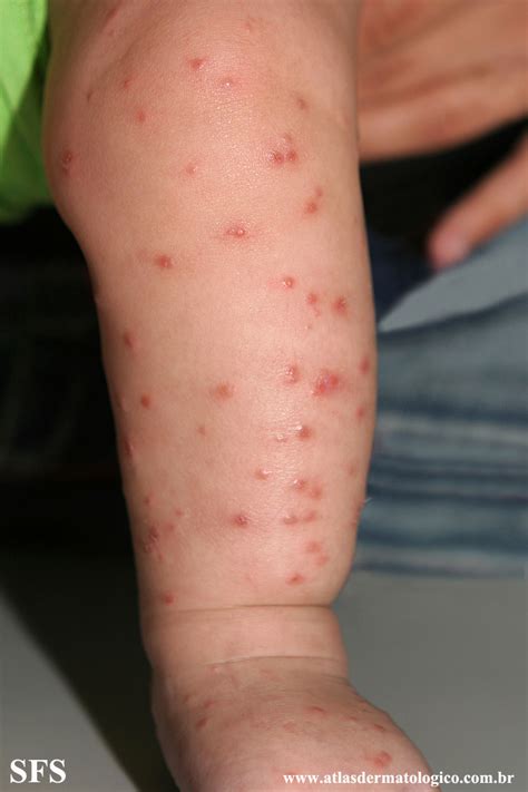 Acrodermatitis Infantile Papular Nc Commons