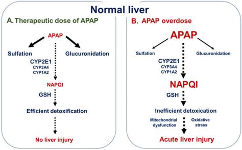Acetaminophen Toxicity Liver