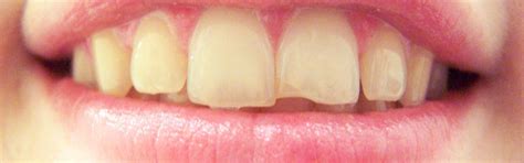What To Do If You Chip A Tooth Kenmore Wa Kenmore Smiles