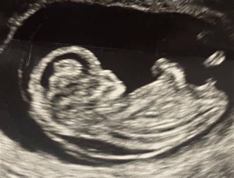 12 Week Ultrasound Nuchal Translucency