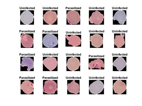 deep learning for medical imaging malaria detection artificial intelligence matlab and simulink