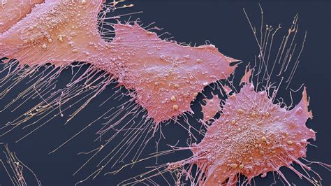 Potential Treatment Advance Against Osteosarcoma Newsroom Albert