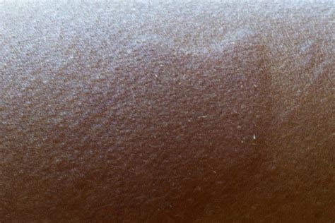 Blanching Rash When Is A Skin Press Serious