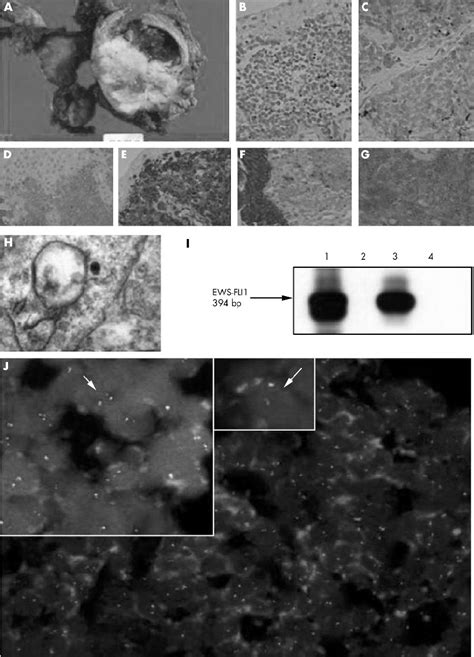 Primary Peripheral Primitive Neuroectodermal Tumour Of The Urinary Download Scientific Diagram
