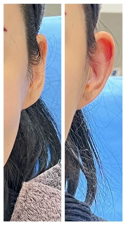 누운귀 접힌귀 교정 원하신다면 필독 귀필러 엘프귀 엘프귀필러 Youtube