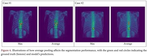 Scientific Research Publishing On Linkedin Bonemetastases Lesion