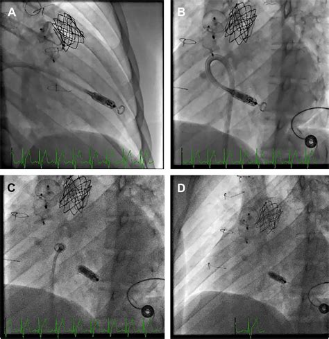 Leadless Pacemakers In Patients With Congenital Heart Disease Cardiac