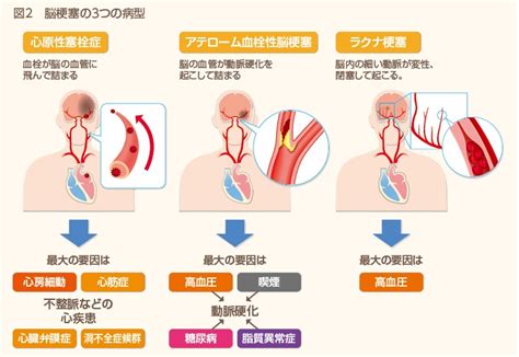 その症状、もしかして脳卒中？どうする？｜脳梗塞・脳出血｜循環器病のトピックス｜公益財団法人 日本心臓財団