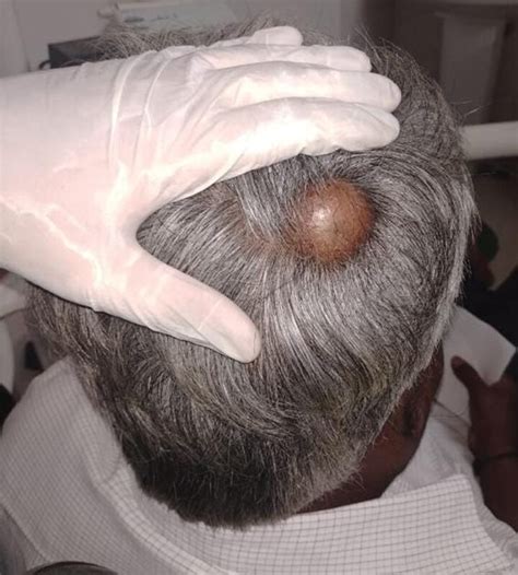 Presence Of A Well Circumscribed Swelling On The Scalp Soft On