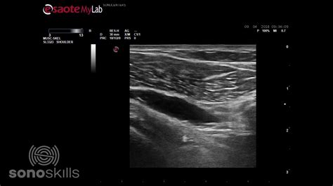 Subcoracoid Bursitis