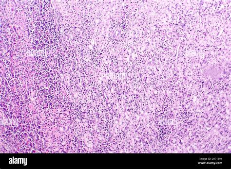 Histopathology Of Chronic Cholecystitis Light Micrograph Hematoxylin