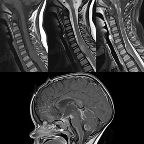 Pediatric Diffuse Leptomeningeal Glioneuronal Tumor Pediatric Radiology Reference Article