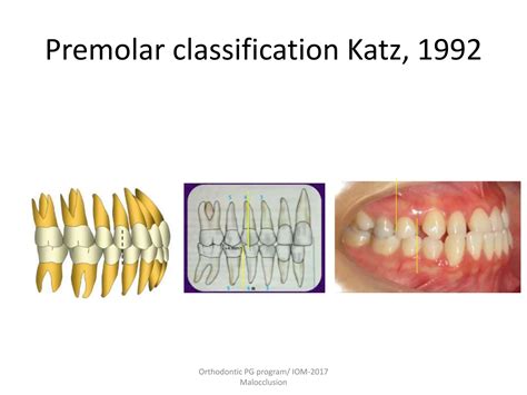 Classification Of Malocclusionpptx